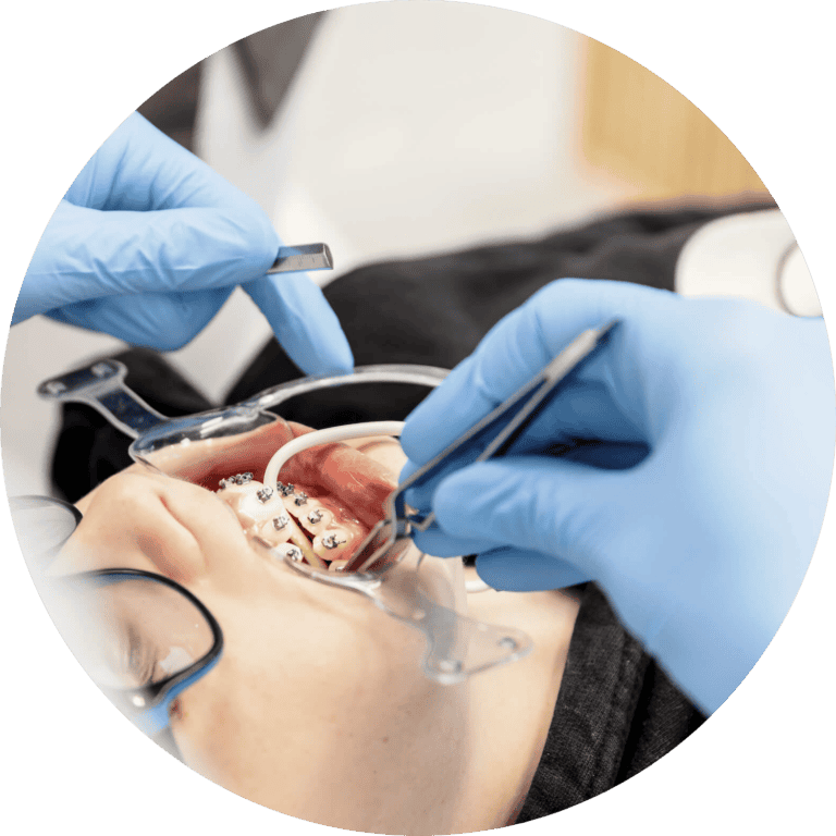 Beugel kapot - Orthodontiepraktijk Lent